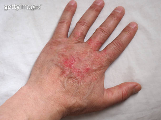 Thermal burn of the skin of the hand. Scars on the hand after healing ...