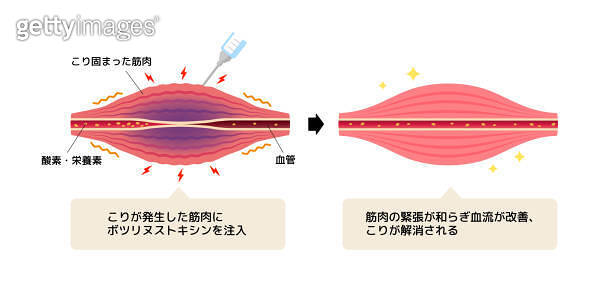 Mechanism of muscle relaxation by botulinum toxin injection (2161097107 ...