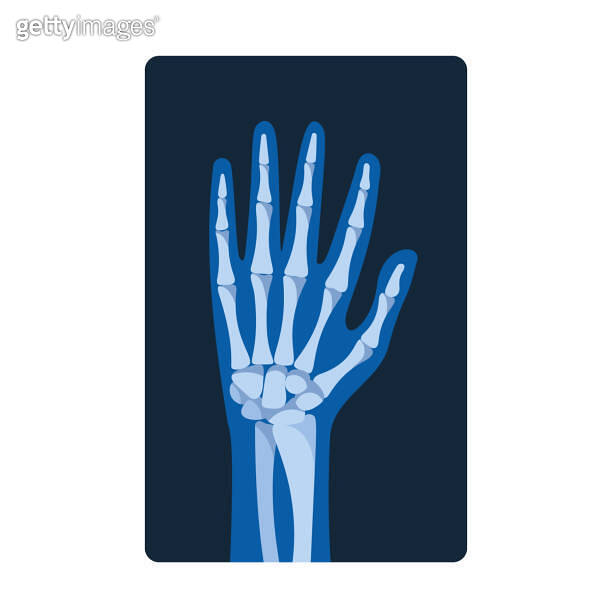 X-ray Pictures Of The Hand Reveal Internal Bone Structures, Joints, And ...