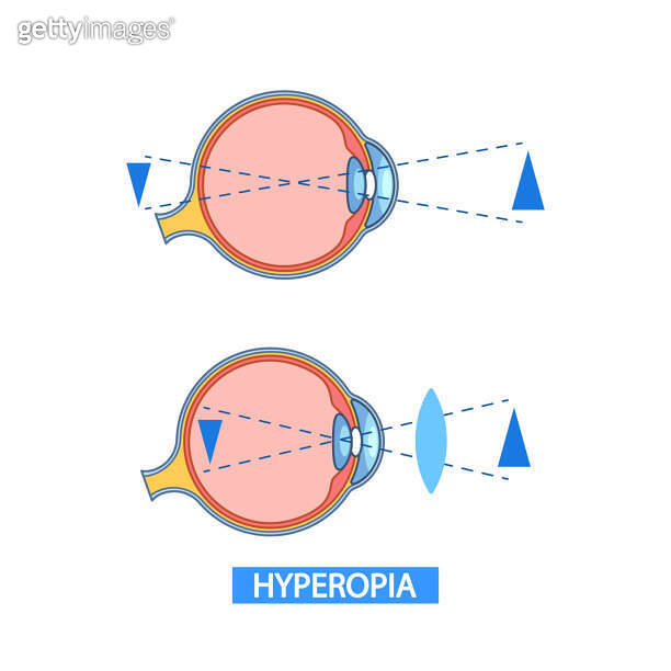 Informative Vector Infographic Depicting Hyperopia, Illustrating The ...