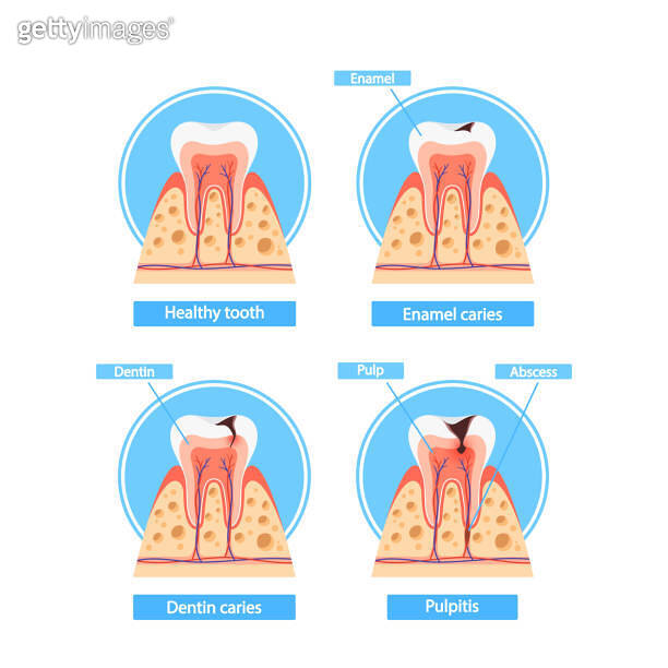 Caries Stages Infographics. Healthy Tooth, Enamel Caries, Dentin Caries ...
