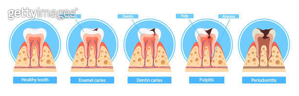 Caries Stages Infographics. Healthy Tooth, Enamel Caries, Dentin Caries ...