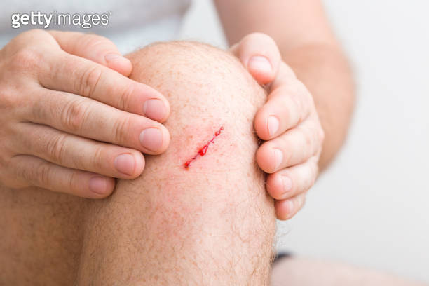 Young adult man hands touching leg with red abrasion bleeding knee skin ...