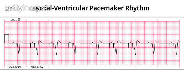 ECG Atrial Ventricular Pacemaker Rhythm - Dual Chamber - 8 Second ECG ...
