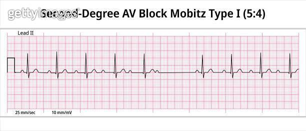 ECG Second Degree AV Block Mobitz Type 1 (5:4) - 8 Second Paper ...
