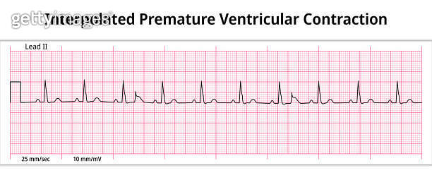 ECG Interpolated Premature Ventricular Contraction - Ventricular ...