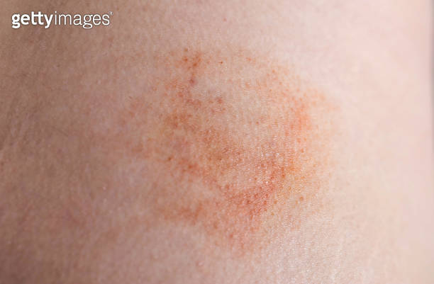 Bruise and subcutaneous lump on the patient s skin after injections ...