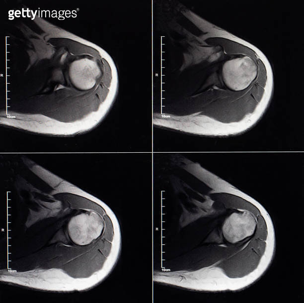 MRI image of the shoulder joint after a fracture and dislocation ...