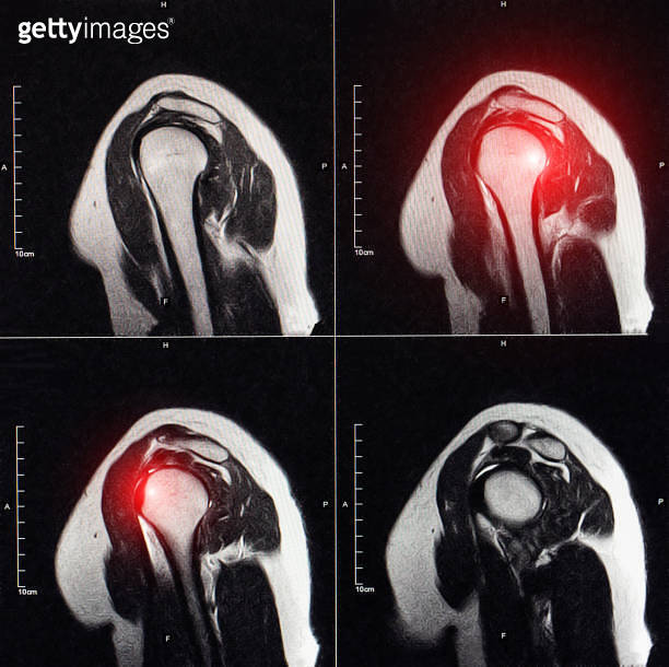MRI image of the shoulder joint after a fracture and dislocation ...