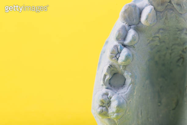 Blue plaster impression of a patient's dental jaw with crooked teeth ...