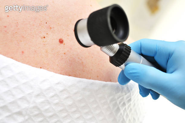 dermatologist oncologist uses a dermatoscope to examine moles and ...