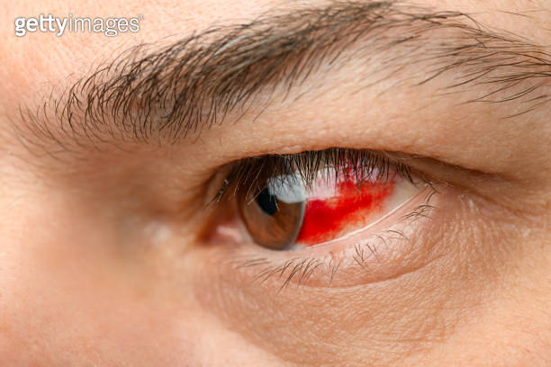 a human eye with a burst vessel and blood leaking into the eyeball ...