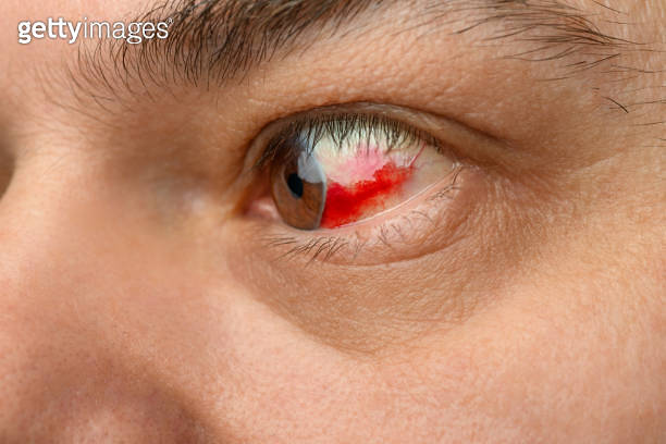 a human eye with a burst vessel and blood leaking into the eyeball ...