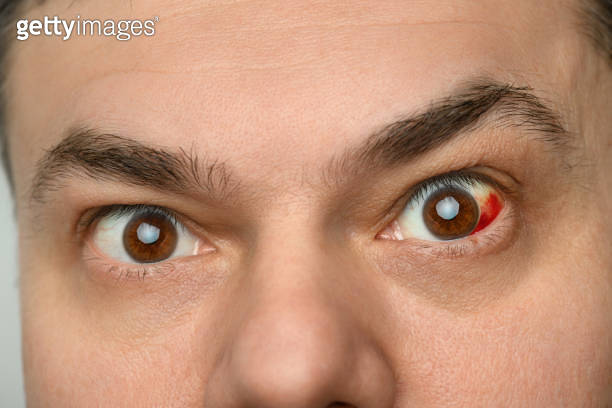a human eye with a burst vessel and blood leaking into the eyeball ...