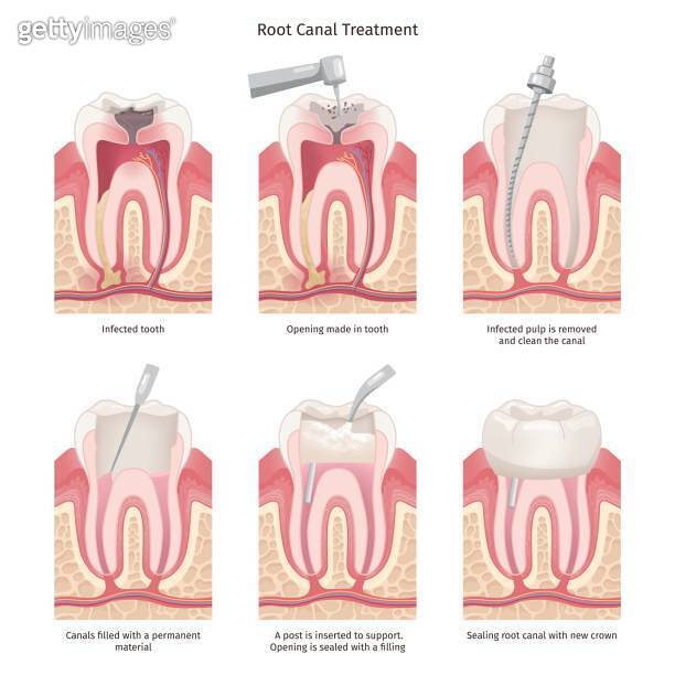 Root canal treatment. Tooth canal rooth filling endodontic procedure ...