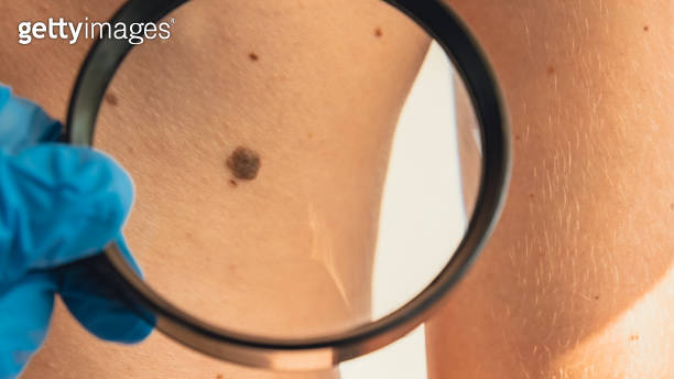 Unrecognizable Dermatologist examining patient's birthmark with ...