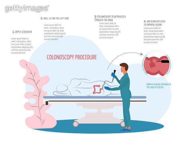 Colonoscopy procedure.Medical illustration showing the steps of a ...