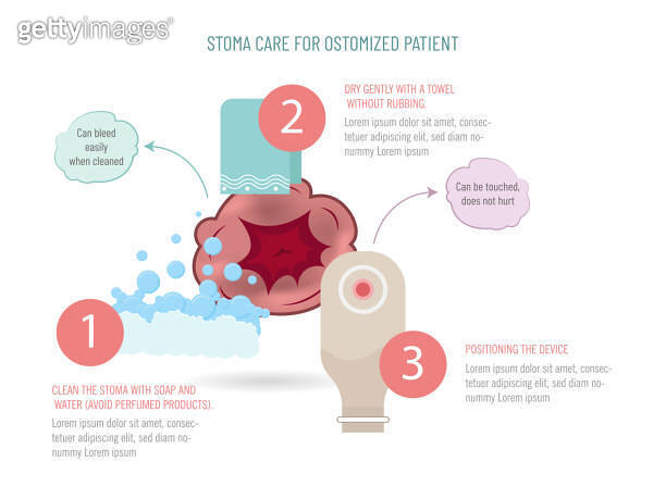 Visual guide for stoma care in ostomized patients (2162097150) - 게티이미지뱅크