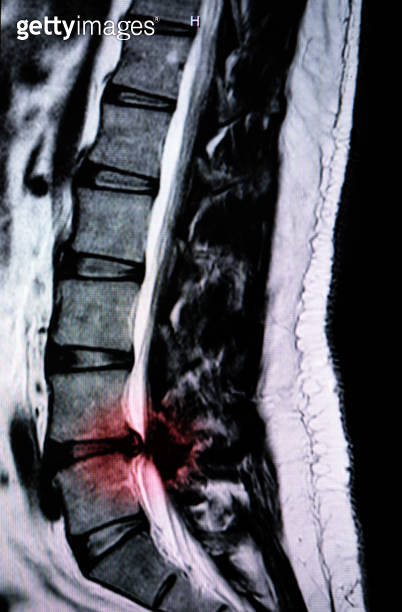 MRI scan of lateral lumbar vertebral column showing L4-L5 disc ...