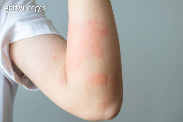 Young asian man itching and scratching on arm from allergic itchy dry ...