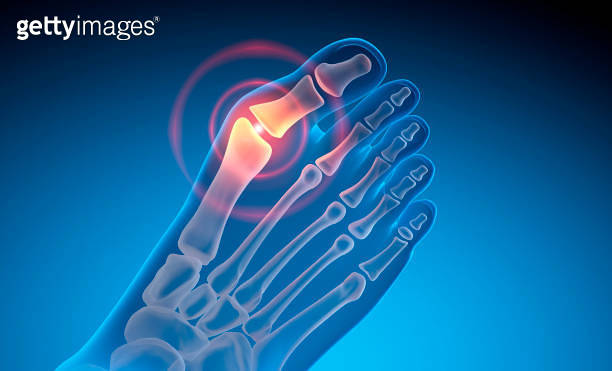 Bunion - Valgus deformity of the big toe 이미지 (2168780401) - 게티이미지뱅크