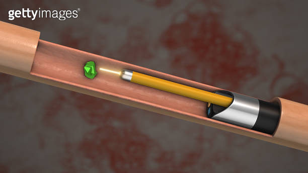 Laser lithotripsy with ureteroscopy for the treatment of kidney stones ...