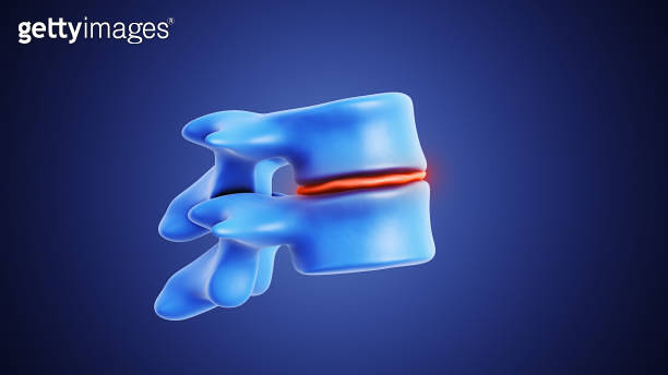 Thinning disc disease affecting the spine 이미지 (2154386397) - 게티이미지뱅크