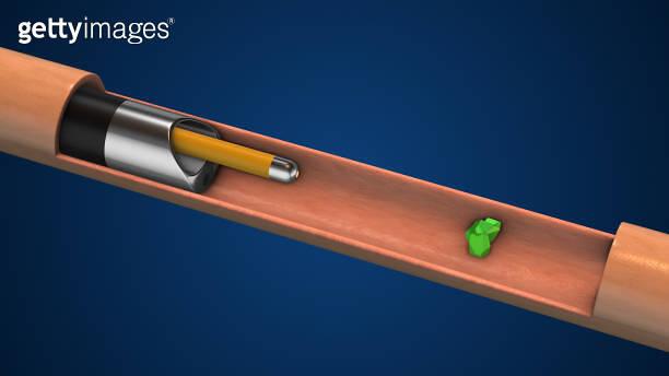 Ureteroscopy with Laser Lithotripsy Treatment for Kidney Stones ...