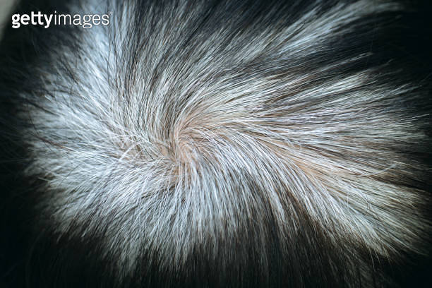 Back view of young people premature gray hair, showing black hoary hair ...