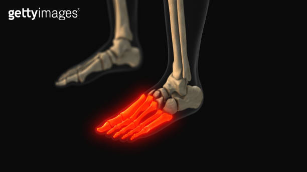 Medical animation of the metatarsal and phalanges bone pain (1934488646 ...
