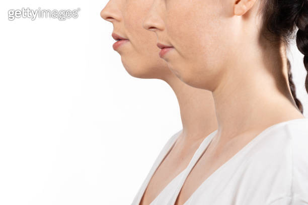 Overbite dental occlusion. Woman's face before and after correction of ...