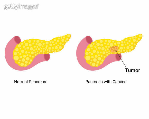 normal and pancreas with cancer human internal organ anatomy tumor ...