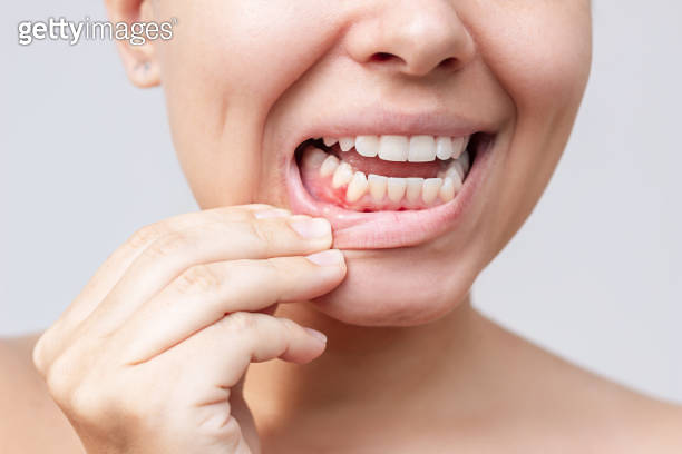 A red lump on the gum near the tooth. Gingivitis, gum inflammation ...