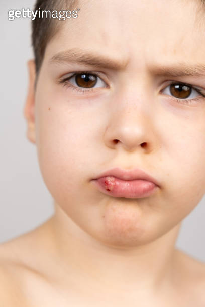 Portrait of a Serious Child with Injured Lip, Wound, Abrasion on Lip ...