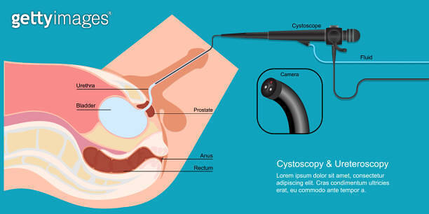 Cystoscopy allows a health care provider to view the lower urinary ...