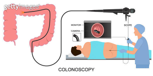 Colonoscopy is a procedure to look inside the colon. (2162348271) 일러스트 ...