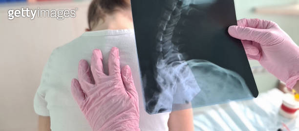 Pediatrician doctor examines x-ray of child spinal deformity ...
