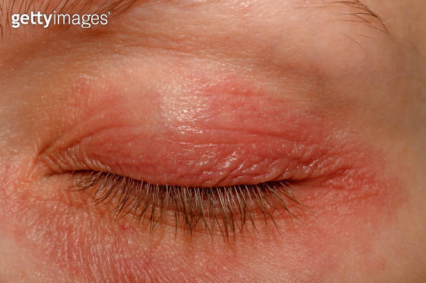 Inflammation of the eyelids, very red, burning skin around the eyes 이미지 ...