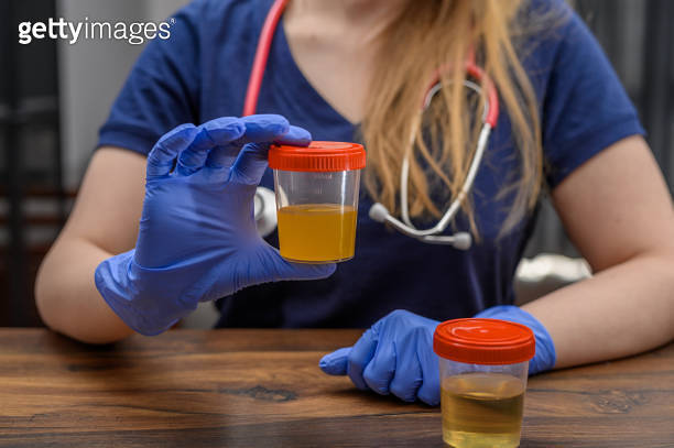 Thick orange cloudy urine, sample in a container for analysis 이미지 ...