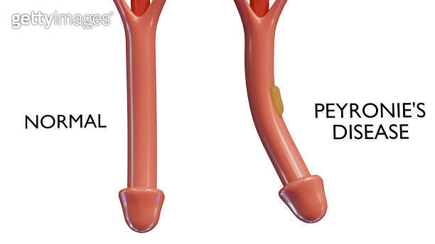 3d rendering of Peyronie's disease penis's erectile tissue curve or ...