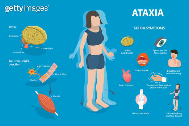 3D Isometric Flat Vector Conceptual Illustration of Ataxia (2113462164 ...