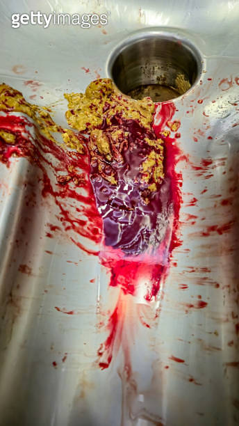 Human feces with blood. Blood in stool caused by hemorrhoids ...