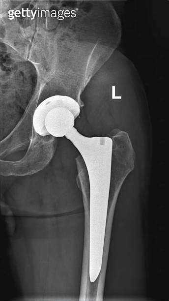 X-ray of left hip prosthesis. AP view. 12 weeks after total hip ...