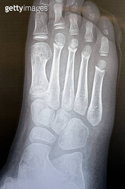 Plain x ray of the right foot of a 9 years old child shows normal ...