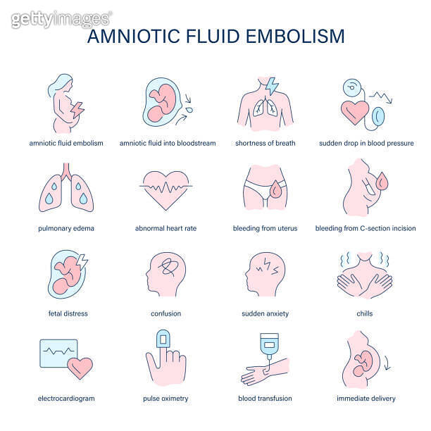 Amniotic Fluid Embolism symptoms, diagnostic and treatment vector icons ...