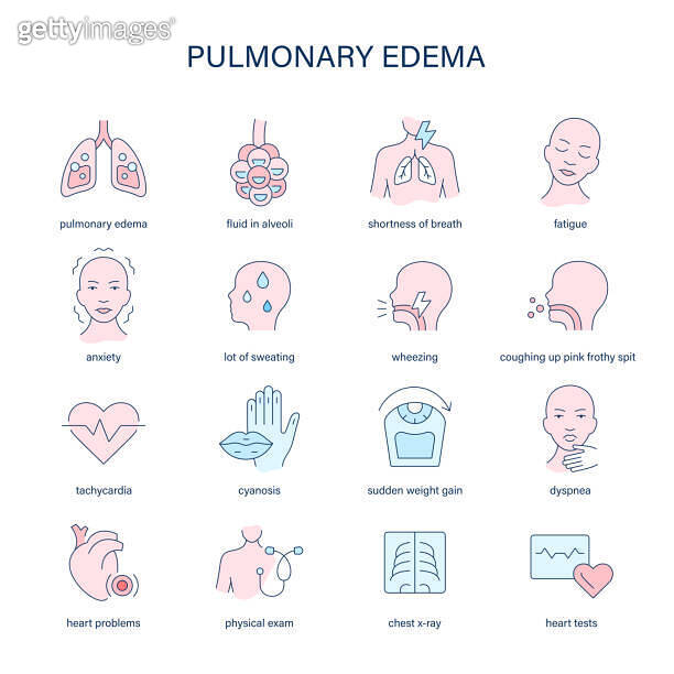 Pulmonary Edema symptoms, diagnostic and treatment vector icons ...