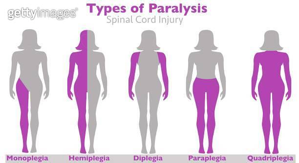 Palsy, spinal cord injury, paralysis types. Monoplegia, paraplegia ...