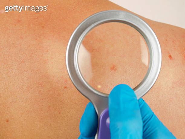 Skin examination by a dermatologist: examination of moles and ...