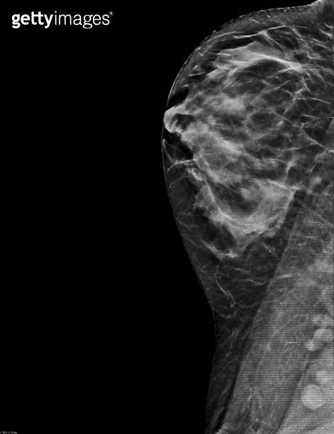 Mammogram. Left mediolateral oblique (MLO) view (with tomosynthesis and ...