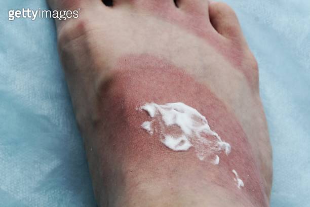 Redness of woman's leg as result of skin burn with cream treatment ...